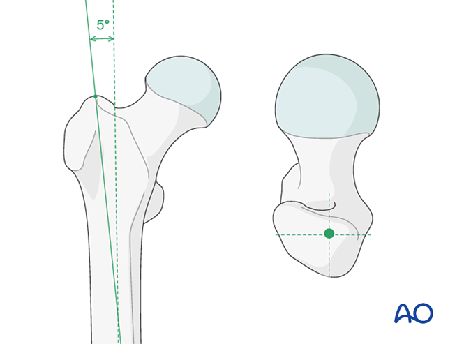 Nailing (short nail) for Intertrochanteric fractures