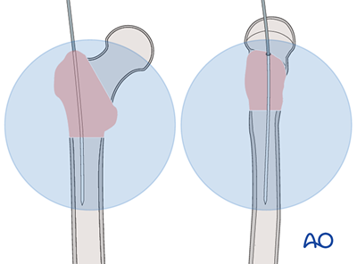 Nailing (short nail) for Intertrochanteric fractures