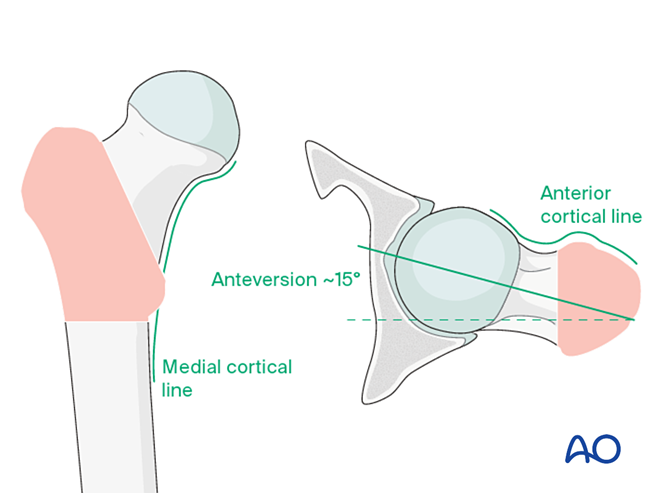 Nailing (short nail) for Intertrochanteric fractures