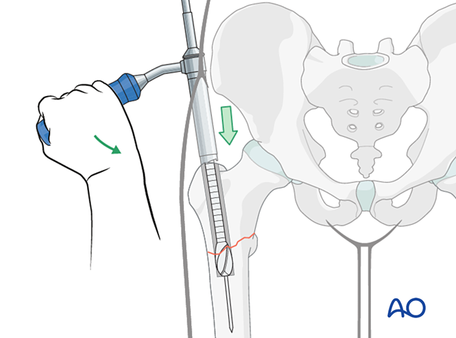 Nailing (short nail) for Intertrochanteric fractures