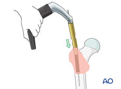 Nailing (short nail) for Intertrochanteric fractures