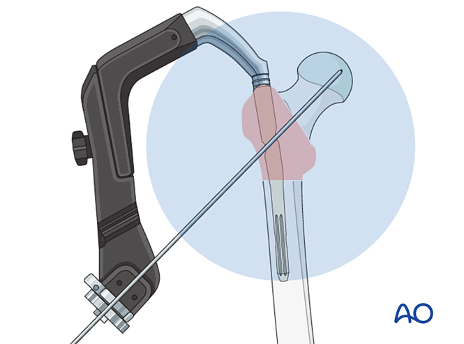 Nailing (short nail) for Intertrochanteric fractures