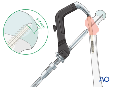 Nailing (short nail) for Intertrochanteric fractures