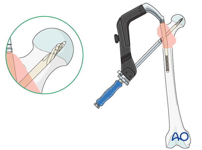Nailing (short nail) for Intertrochanteric fractures