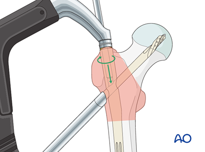 Nailing (short nail) for Intertrochanteric fractures