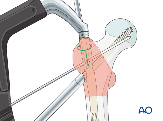Nailing for Simple pertrochanteric fractures with posteromedial involvement