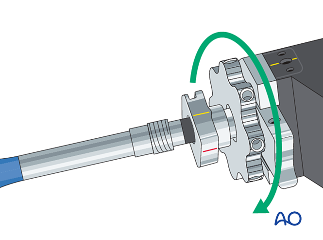 Nailing (short nail) for Intertrochanteric fractures