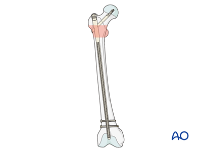 Nailing (long nail) for Intertrochanteric fractures
