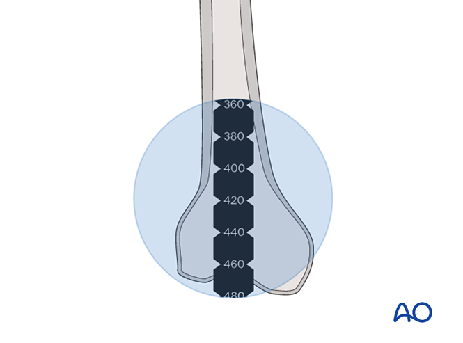 Nailing (long nail) for Intertrochanteric fractures