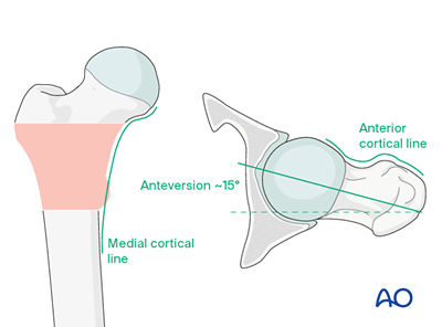 Nailing (long nail) for Intertrochanteric fractures