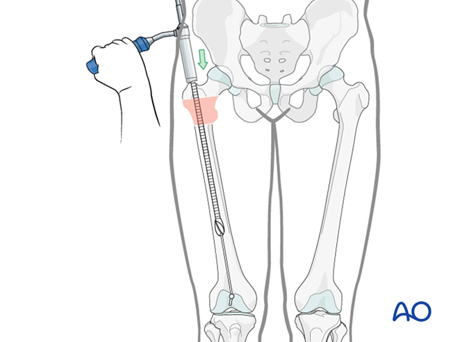 Nailing (long nail) for Intertrochanteric fractures