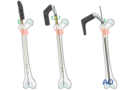 Nailing (long nail) for Intertrochanteric fractures