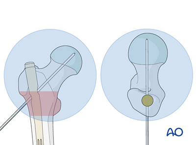 Nailing (long nail) for Intertrochanteric fractures