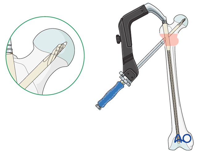 Nailing (long nail) for Intertrochanteric fractures