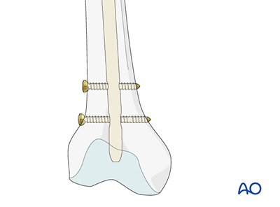 Nailing (long nail) for Intertrochanteric fractures