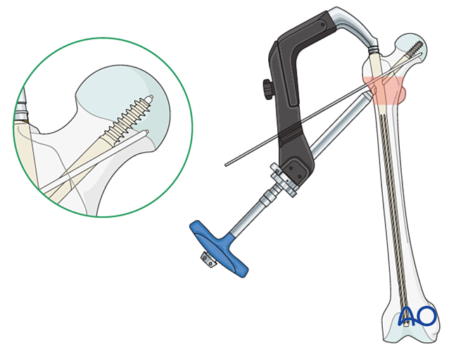 Nailing (long nail) for Intertrochanteric fractures