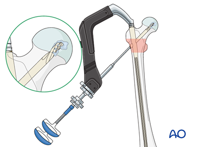 Nailing (long nail) for Intertrochanteric fractures
