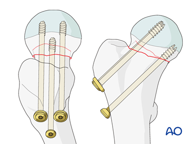 Cannulated screws for Impacted or nondisplaced subcapital femoral neck ...