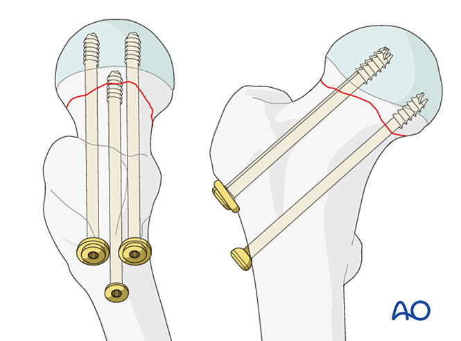 Cannulated screws for Displaced subcapital femoral neck fractures