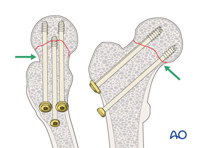Cannulated screws for Impacted or nondisplaced subcapital femoral neck ...