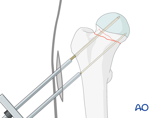 Cannulated screws for Impacted or nondisplaced subcapital femoral neck ...