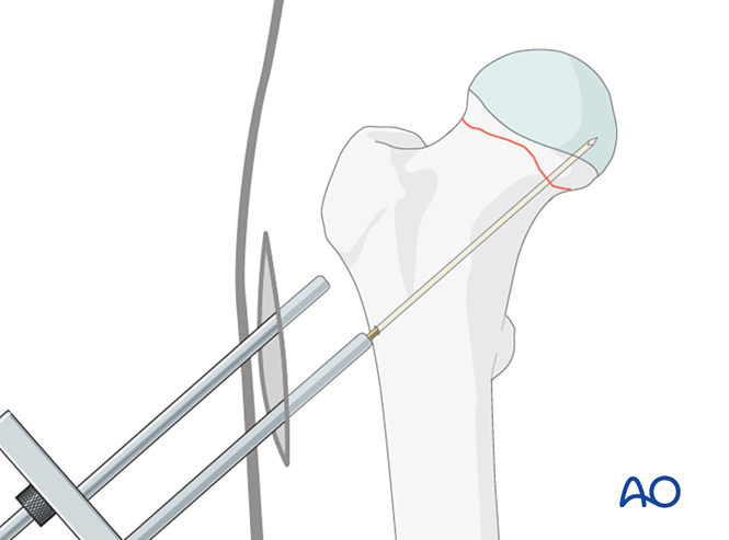 Cannulated screws for Displaced subcapital femoral neck fractures