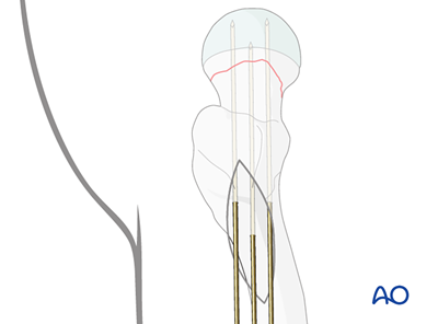 Cannulated screws for Displaced subcapital femoral neck fractures