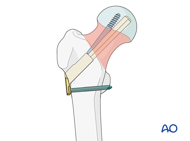 Femoral neck system for Basicervical femoral neck fractures