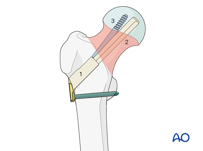 Femoral neck system for Impacted or nondisplaced subcapital femoral ...