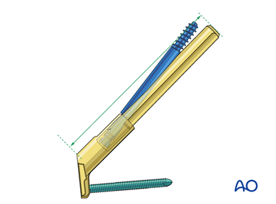 Femoral neck system for Basicervical femoral neck fractures