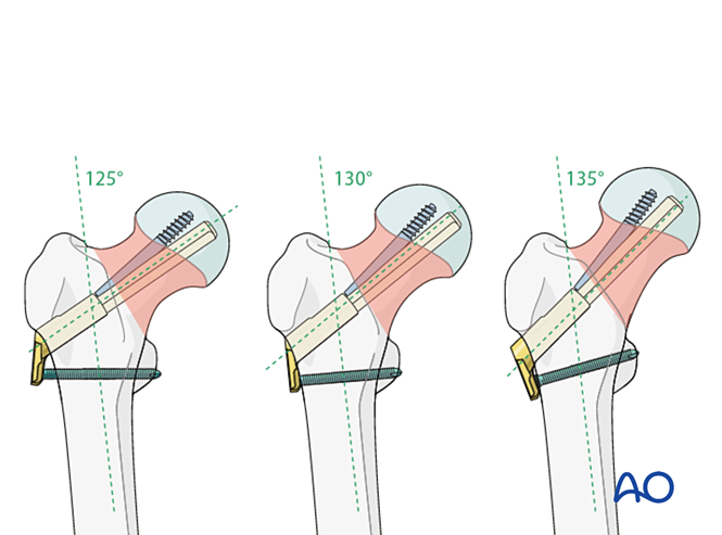 Femoral Neck System For Transcervical Shear Fractures Of The Femoral Neck