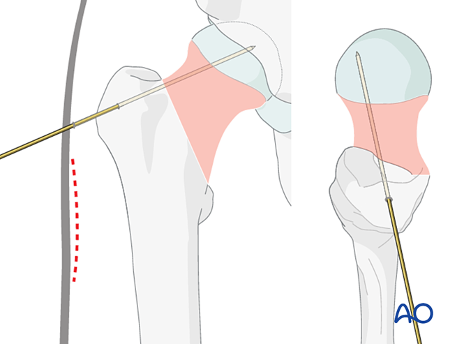Femoral neck system for Basicervical femoral neck fractures