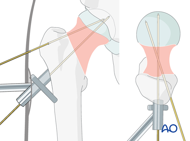 Femoral neck system for Basicervical femoral neck fractures