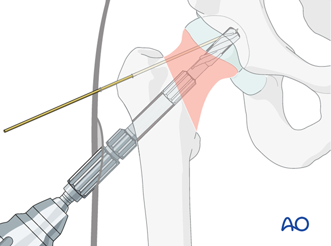 Femoral neck system for Transcervical shear fractures of the femoral neck