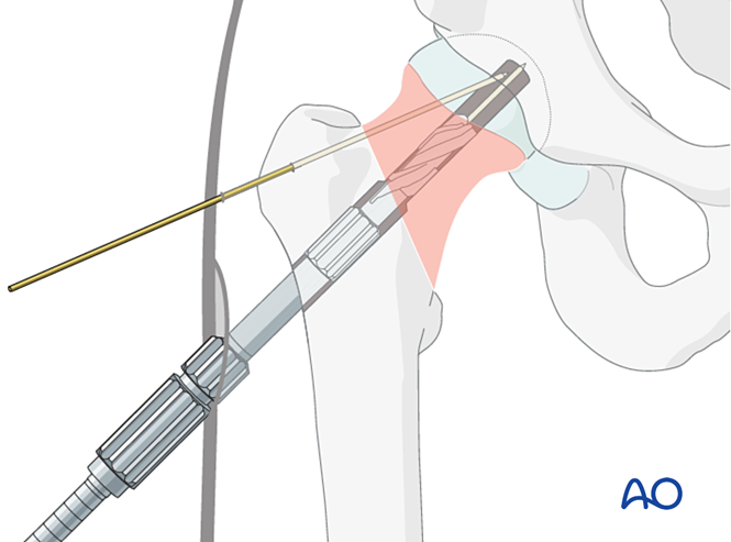 Femoral neck system for Basicervical femoral neck fractures
