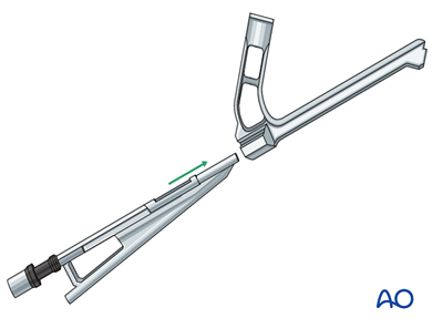 Femoral neck system for Basicervical femoral neck fractures