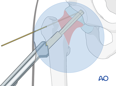 Femoral neck system for Transcervical femoral neck fractures (simple or ...