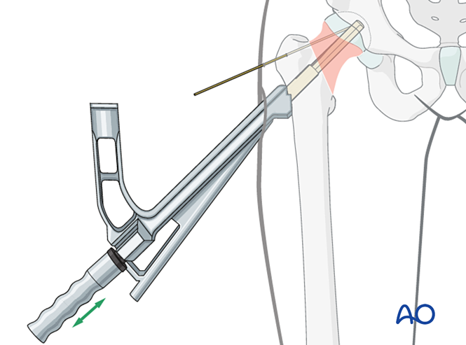 Femoral neck system for Basicervical femoral neck fractures
