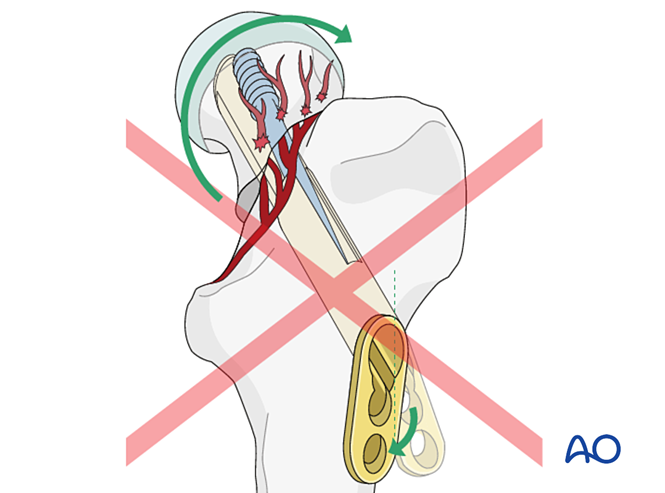 Femoral neck system for Basicervical femoral neck fractures