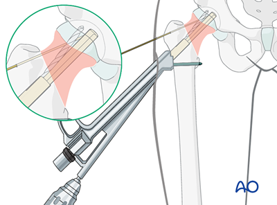 Femoral neck system for Basicervical femoral neck fractures