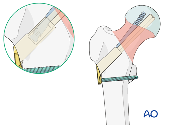 Femoral neck system for Transcervical femoral neck fractures (simple or ...