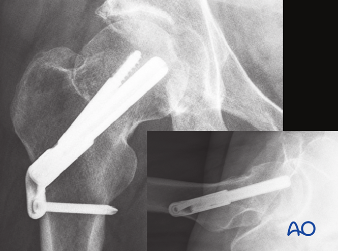 Femoral neck system for Transcervical femoral neck fractures (simple or ...