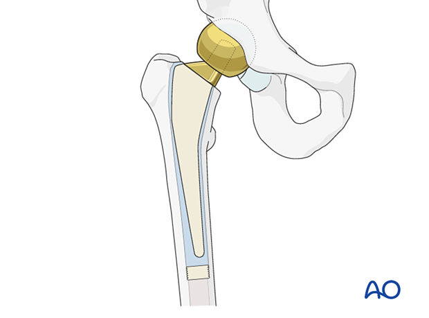 Bipolar Hemiarthroplasty Vs Total Hip Replacement