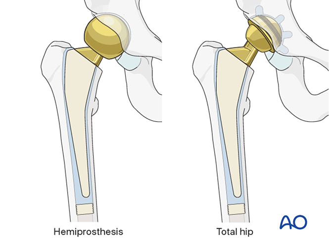 Hemiarthroplasty for Femoral neck and head fractures with hip dislocation