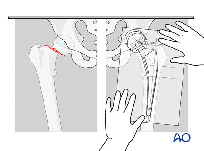 Hemiarthroplasty for Femoral neck and head fractures with hip dislocation
