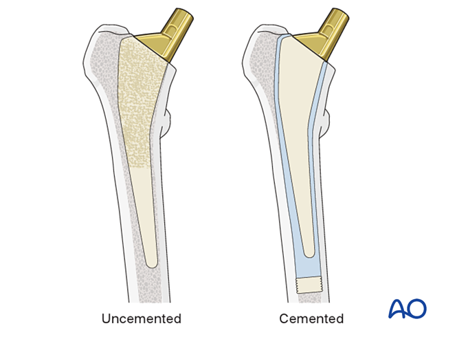 Total hip arthroplasty for Femoral neck and head fractures with hip ...