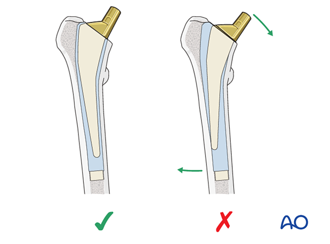 Total hip arthroplasty for Femoral neck and head fractures with hip ...