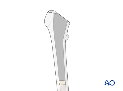 Total hip arthroplasty for Femoral neck and head fractures with hip ...