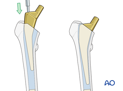 Hemiarthroplasty for Femoral neck and head fractures with hip dislocation
