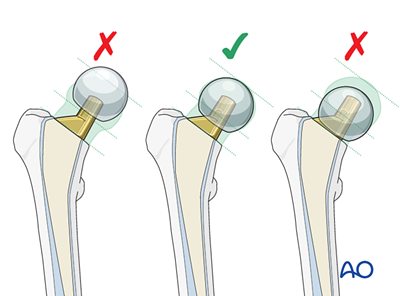 Hemiarthroplasty for Femoral neck and head fractures with hip dislocation